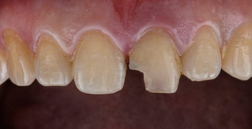 Chipped Tooth Repair: Quick Solutions for Restoring Smile